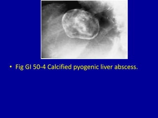 50 liver calcification | PPTX | Medical Health