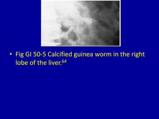 50 liver calcification | PPTX | Medical Health