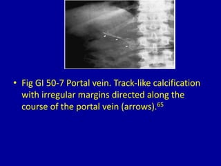 50 liver calcification | PPTX | Medical Health