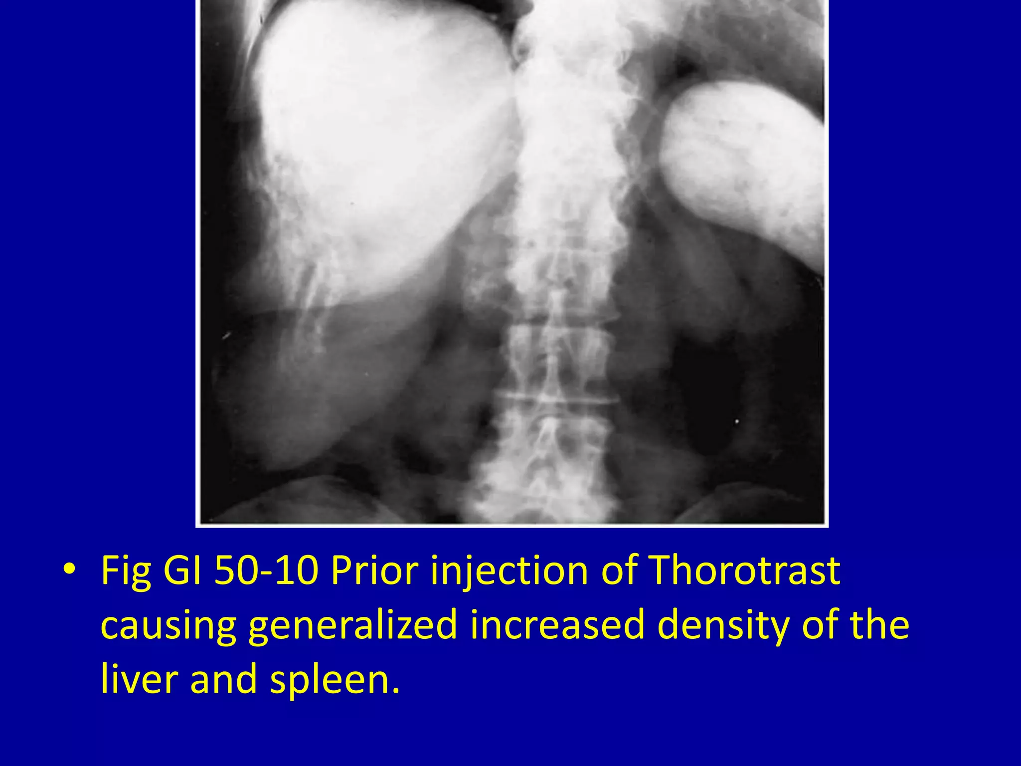 50 liver calcification | PPTX