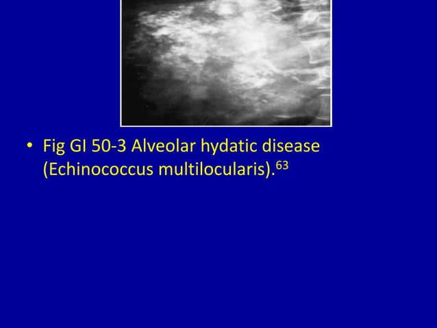 50 liver calcification | PPTX