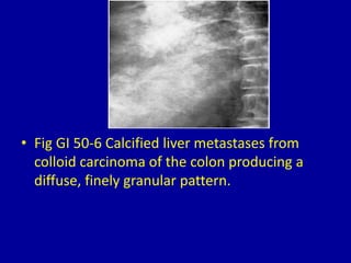 50 liver calcification | PPTX