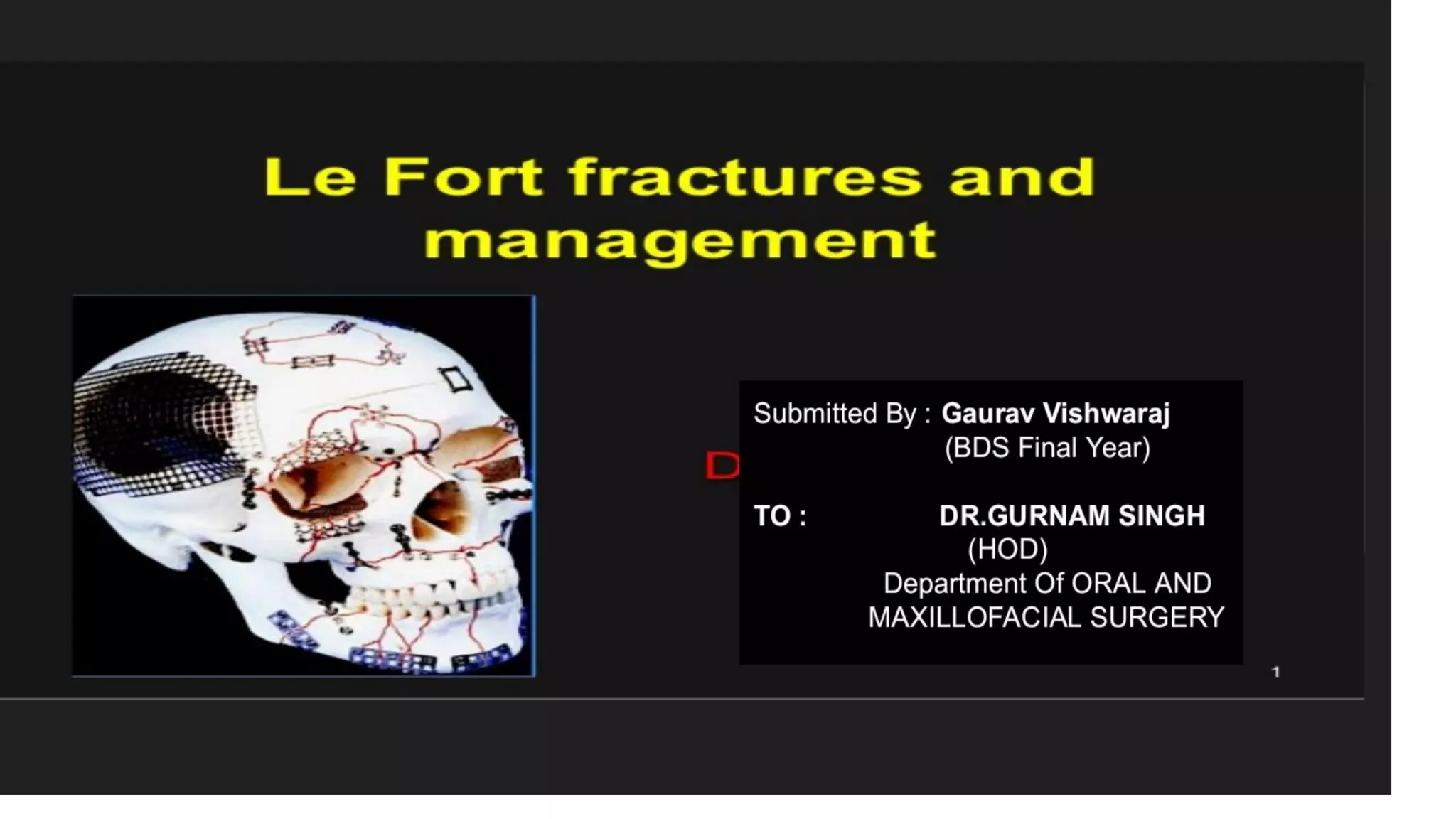 Le Fort Fractures | PPT