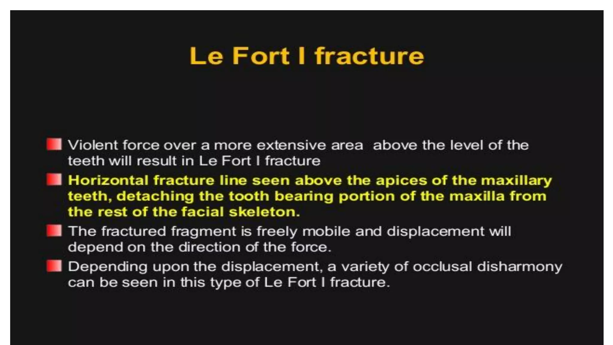 Le Fort Fractures | PPT