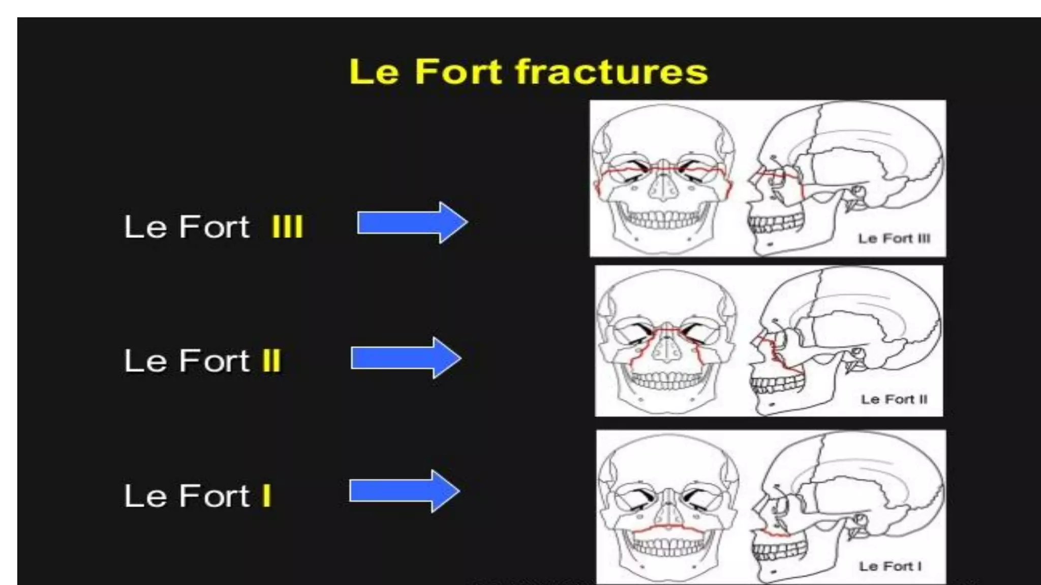 Le Fort Fractures | PDF
