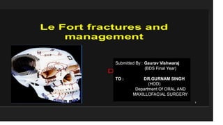 Le Fort Fractures | PPT
