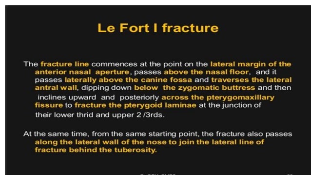 Le Fort Fractures | PPT