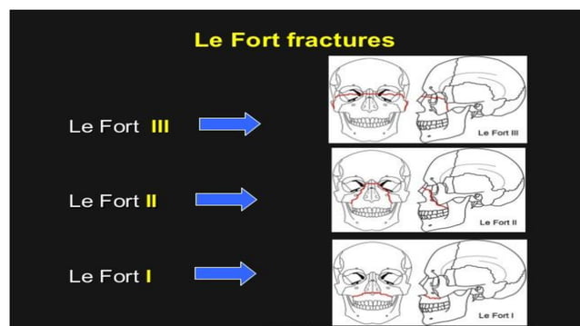 Le Fort Fractures | PPT