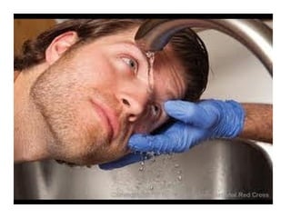 515257129 Eye Irrigation By Dr Raafat Pptx First Aid Injuries