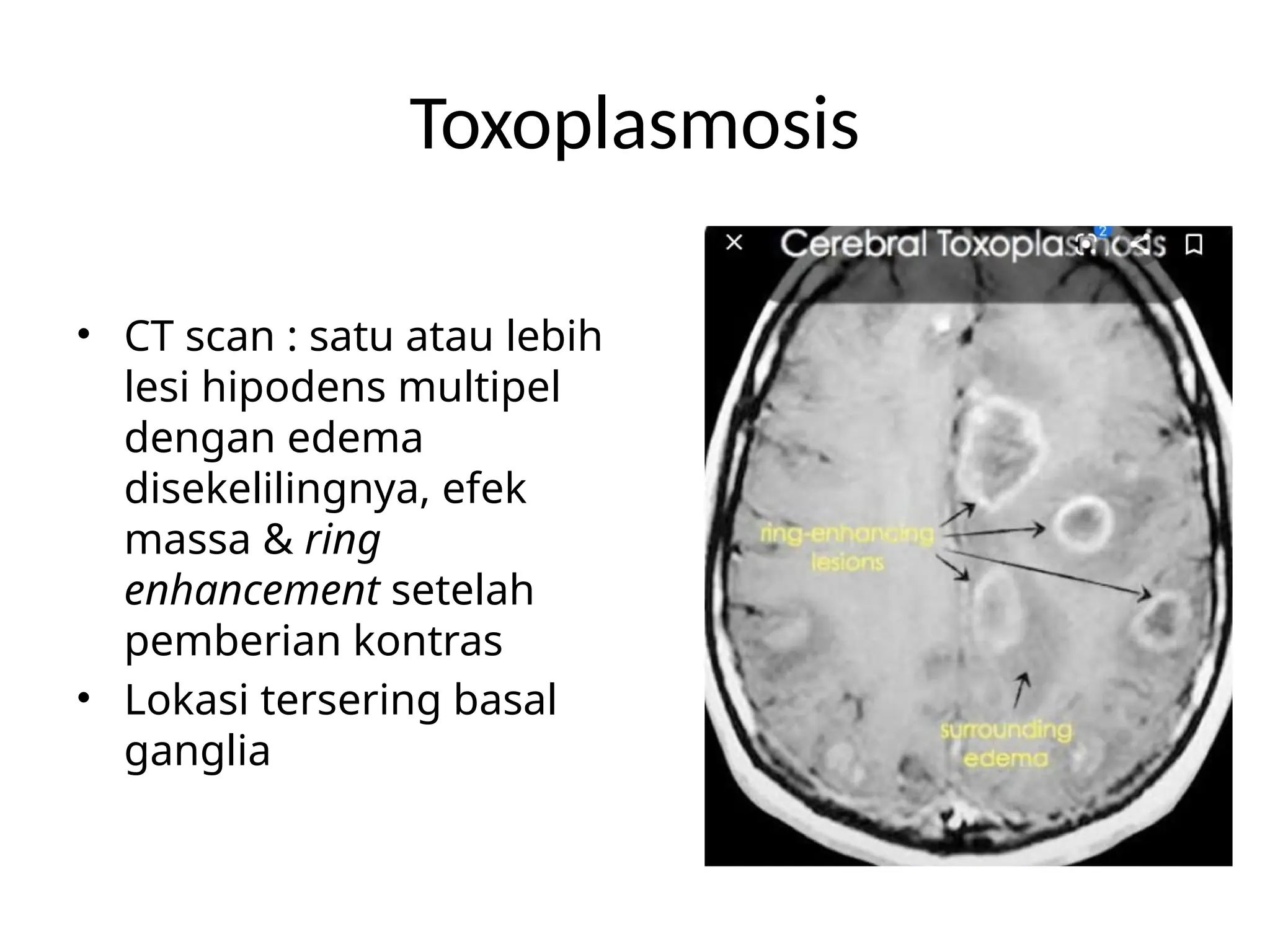 Perbedaan-Gambaran-CT-Scan-Toxoplasmosis-dan-Tuberculoma.pptx