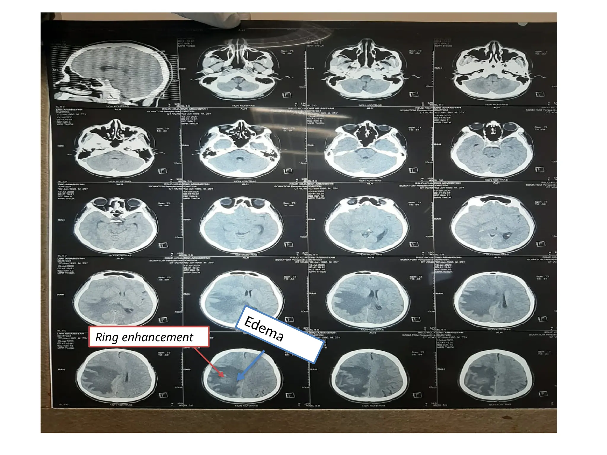 Perbedaan-Gambaran-CT-Scan-Toxoplasmosis-dan-Tuberculoma.pptx