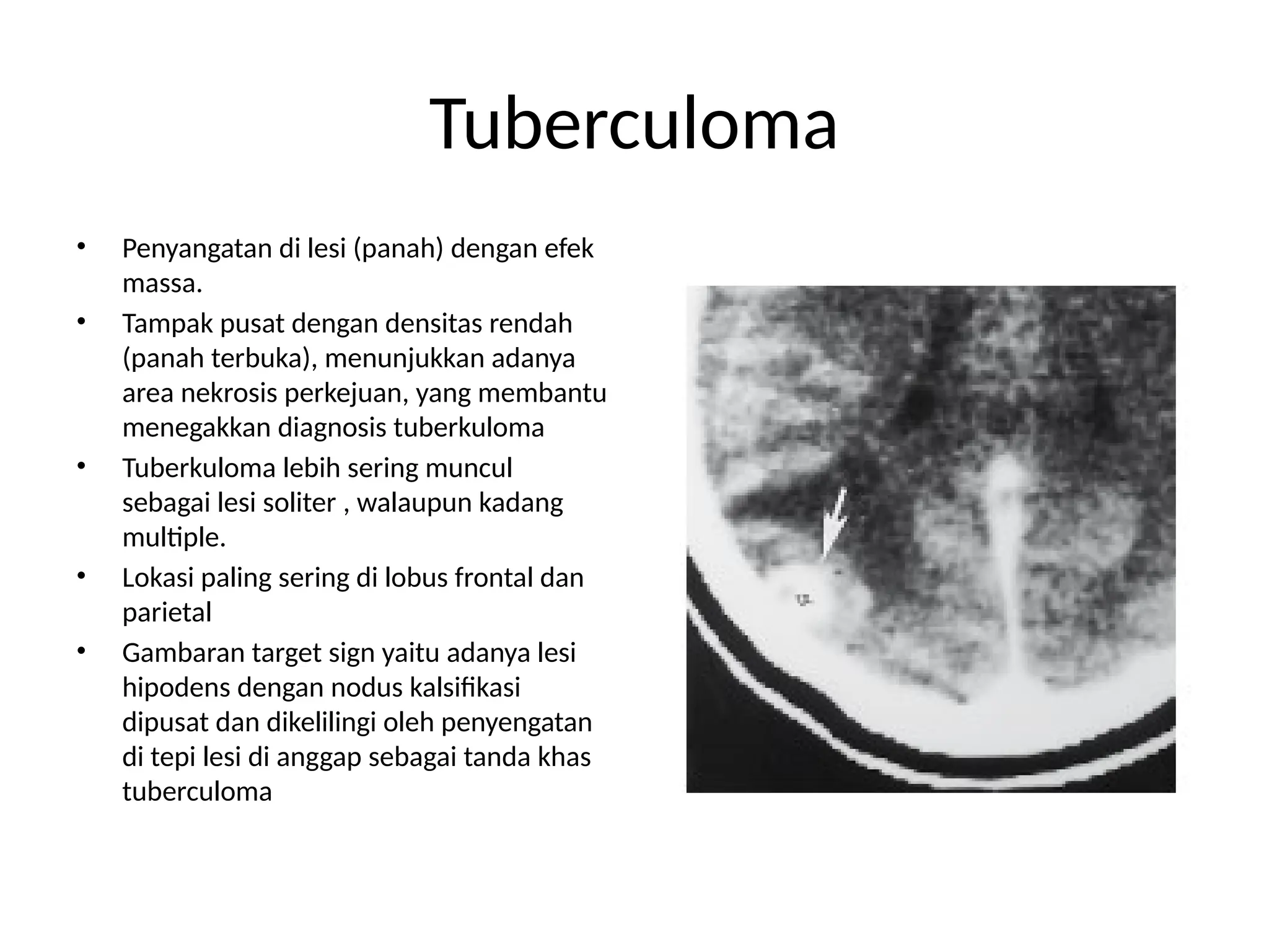 Perbedaan-Gambaran-CT-Scan-Toxoplasmosis-dan-Tuberculoma.pptx