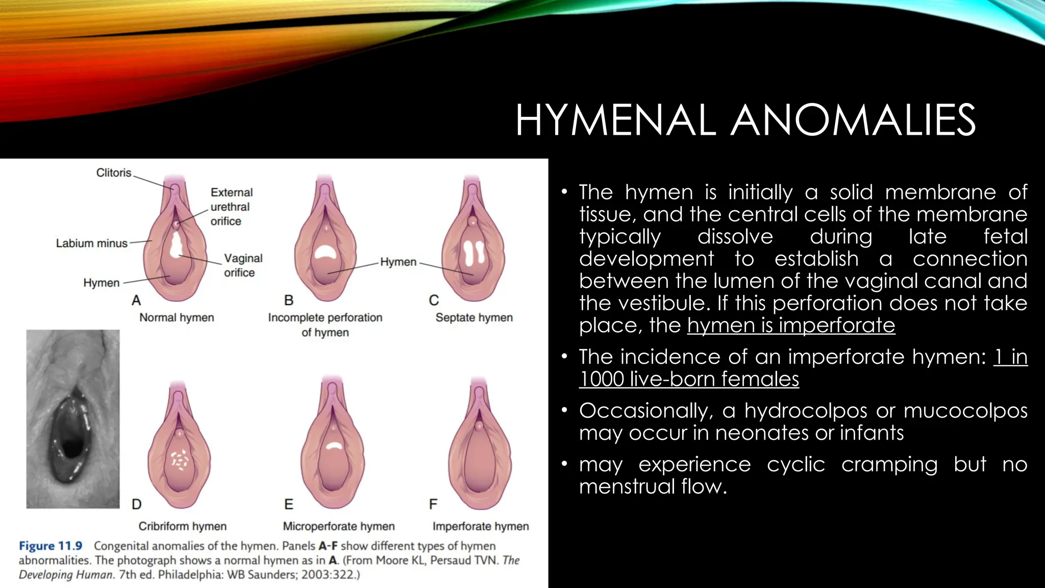 CONGENITAL ABNORMALITIES GYNECOLOGY PEDIATRICS | PPTX