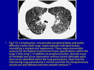51 cystic lung disease on computed tomography | PPTX