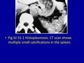 51 spleen calcification | PPT