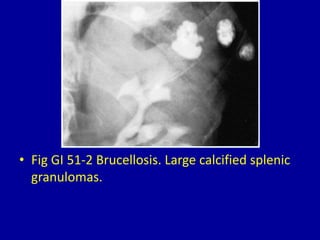 51 spleen calcification | PPTX