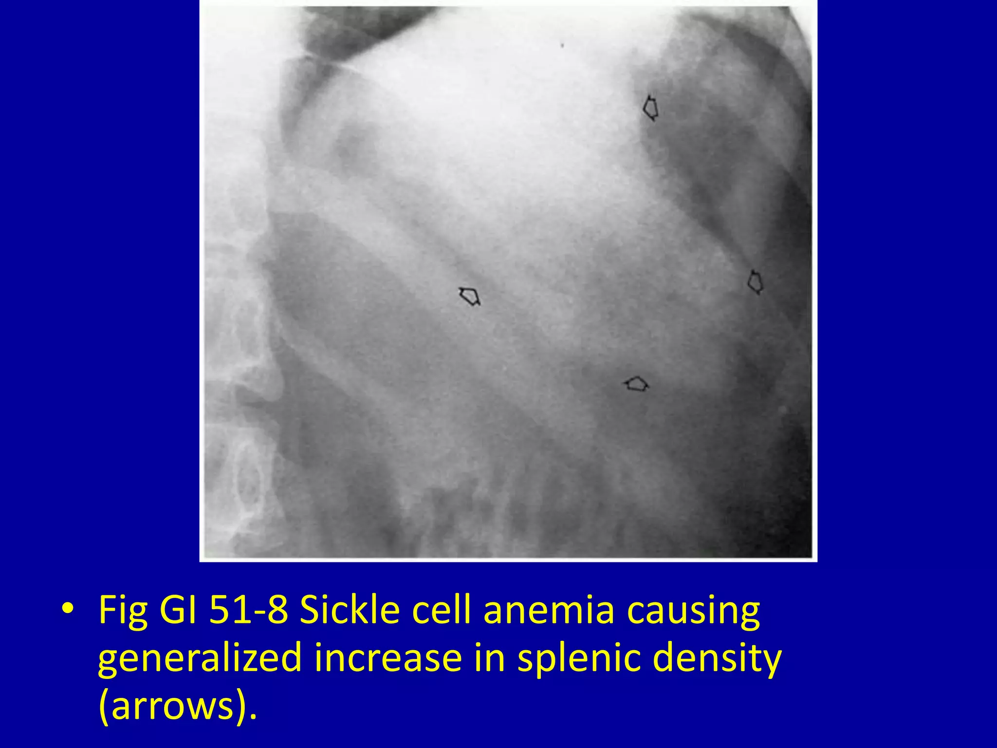 51 spleen calcification | PPTX