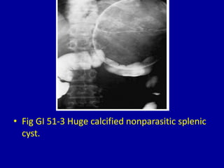 51 spleen calcification | PPTX