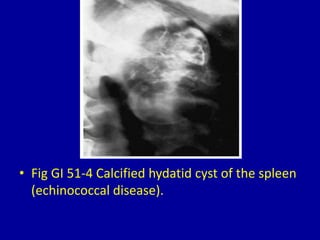51 spleen calcification | PPTX