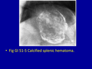 51 spleen calcification | PPTX