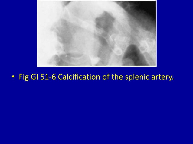 51 spleen calcification | PPTX