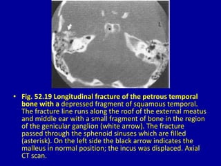 Fracture Petrous Pyramid