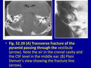 Fracture Petrous Pyramid