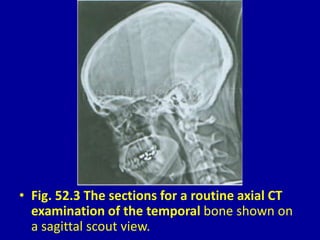 Petrous Ridge Of Temporal Bone