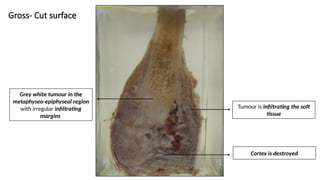 Bone tumors histology pathology and case discussions | PPTX