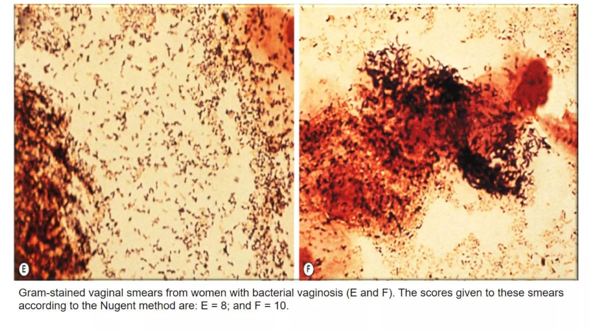 52 Modified 2 Lower Genital Tract Infection 26 8 19 Ppt