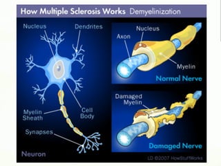 Relapse.Remitting.MS | Brain and Nervous System Disorders | Diseases ...