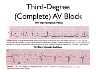5250 17-av-blocks | PPT | Heart and Cardiovascular Diseases | Diseases ...