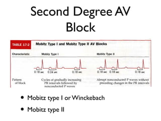 5250 17-av-blocks | PPT | Heart and Cardiovascular Diseases | Diseases ...