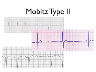 5250 17-av-blocks | PPT | Heart and Cardiovascular Diseases | Diseases ...