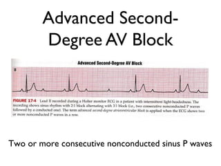5250 17-av-blocks | PPT | Heart and Cardiovascular Diseases | Diseases ...