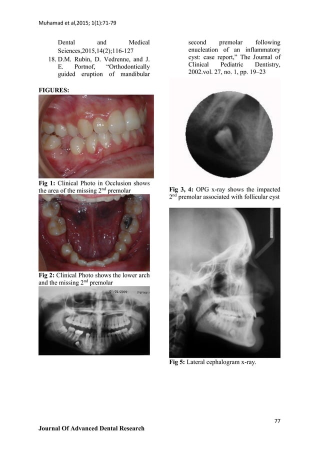MANAGEMENT OF LOWER SECOND PREMOLAR IMPACTION | PDF
