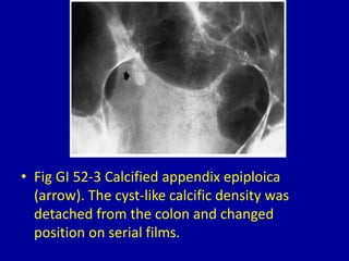 52 alimentary tract calcification | PPT