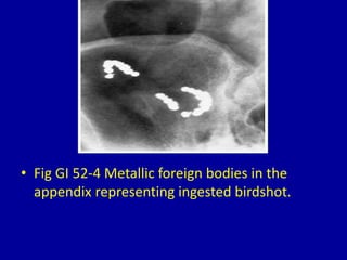 52 alimentary tract calcification | PPT