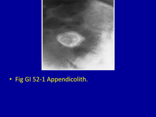 52 alimentary tract calcification | PPTX