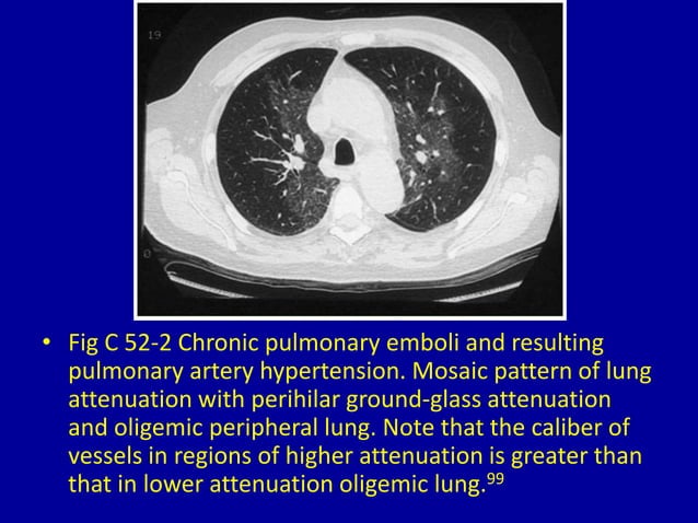 52 mosaic pattern on chest computed tomography | PPTX