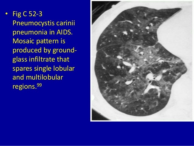 52 mosaic pattern on chest computed tomography