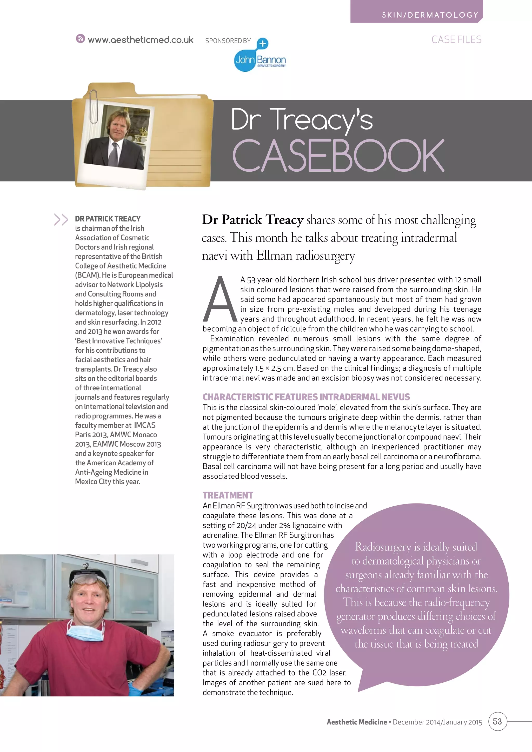 Treating facial intradermal nevi with radiosurgery | PDF