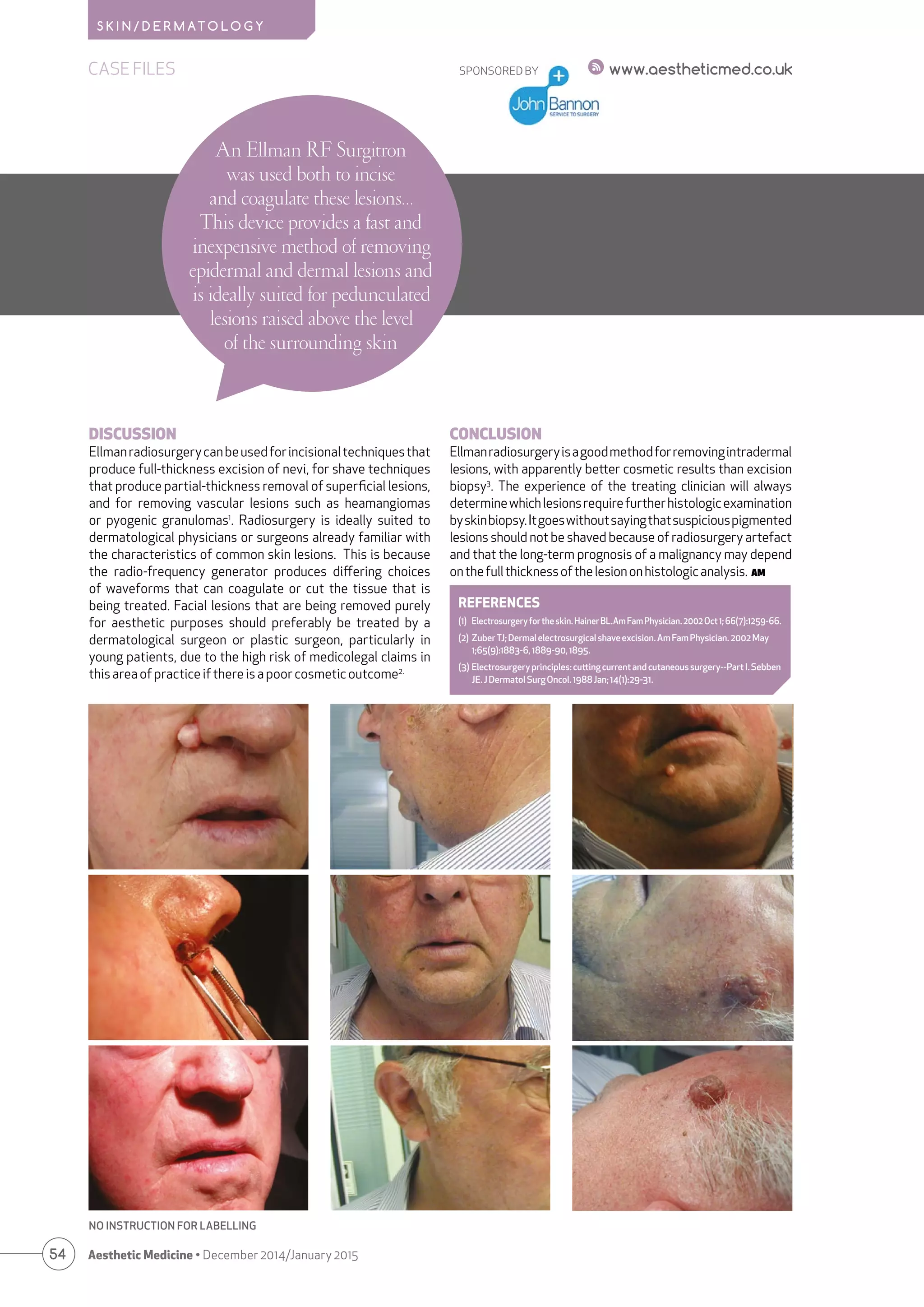 Treating facial intradermal nevi with radiosurgery | PDF