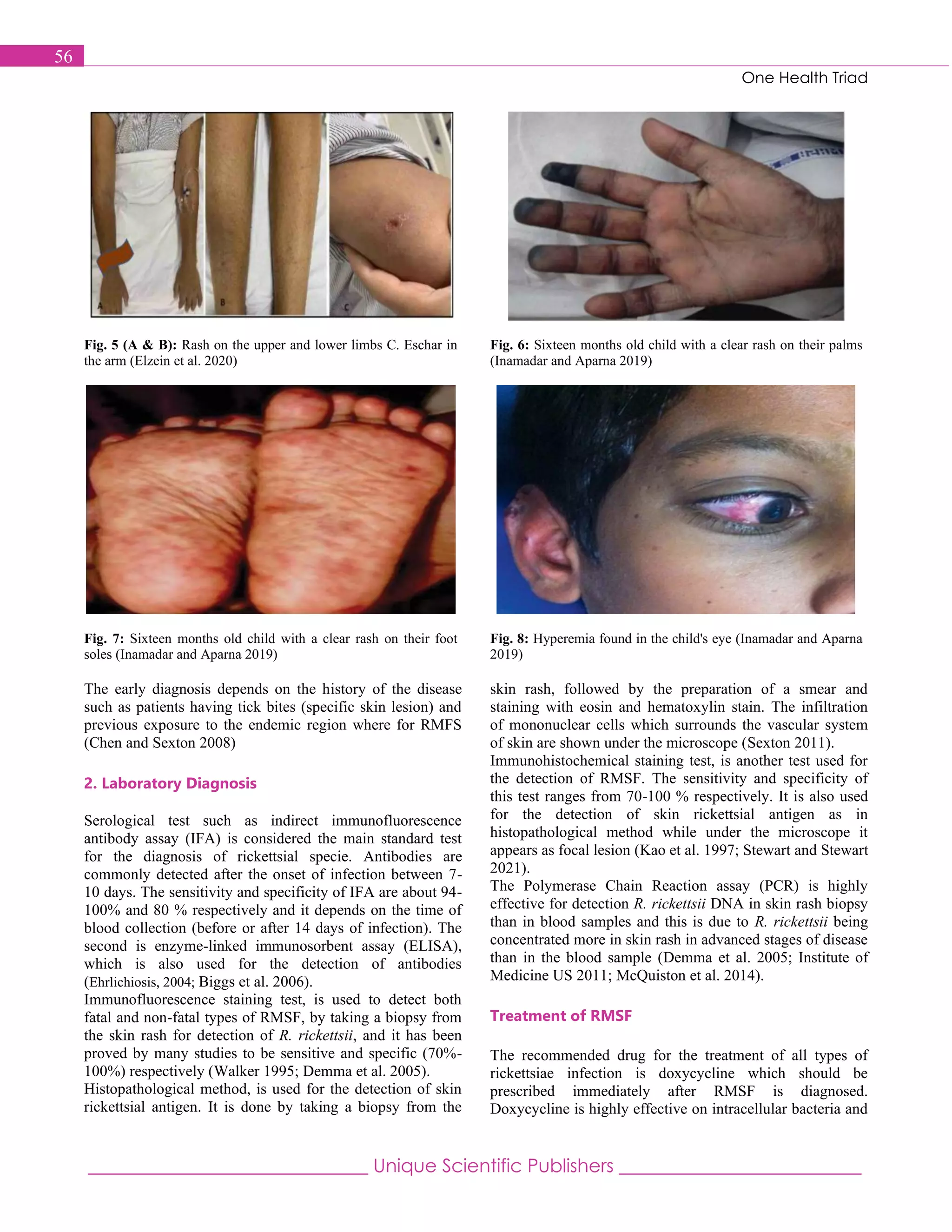 Rocky Mountain Spotted Fever | PDF