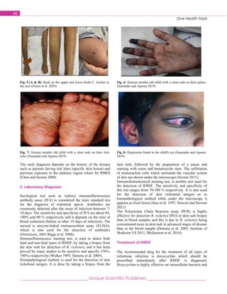 Rocky Mountain Spotted Fever | PDF