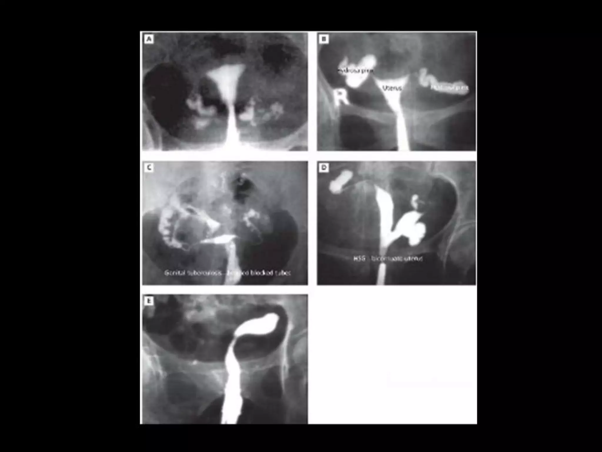 53 Dr Ahmed Esawy imaging oral board of female pelvis part III HSG MRI FETAL MRI | PPT