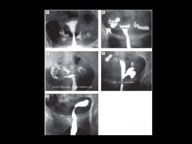 53 Dr Ahmed Esawy Imaging Oral Board Of Female Pelvis Part Iii Hsg Mri
