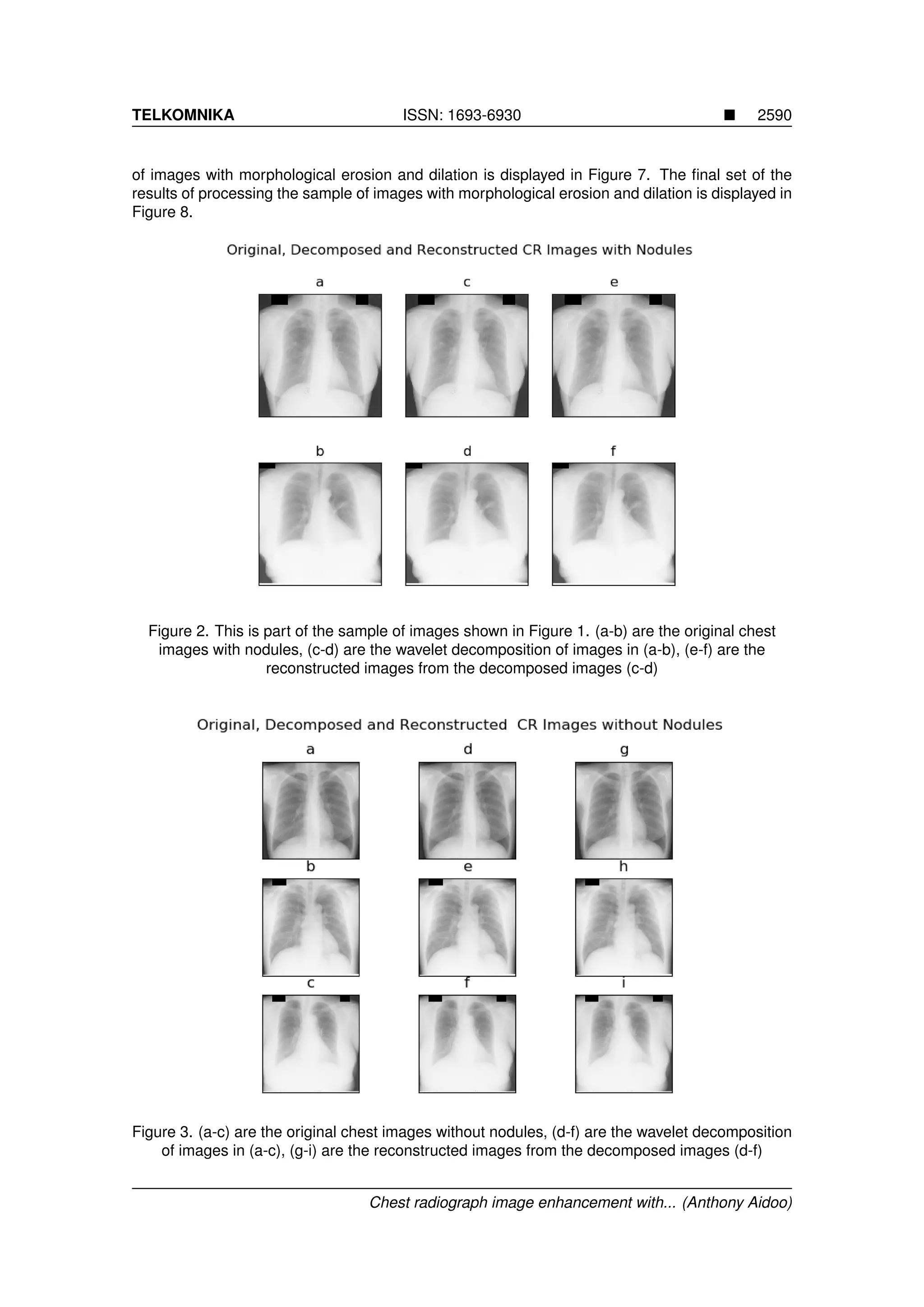 Chest radiograph image enhancement with wavelet decomposition and morphological operations | PDF