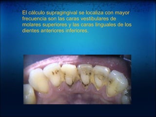ODO 301Funcion del Calculo Dental y otros factores predisponentes | PPT