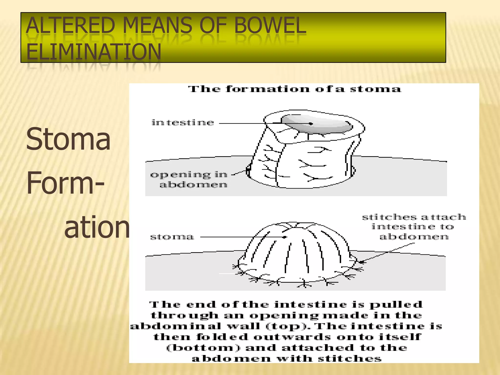 elimination, nursing | PPTX